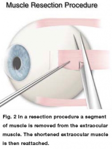 Strabismus Surgery | Costello Eye Physicians & Surgeons