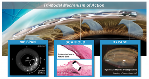 hydrus animation of stent in eye 3 mechanisms - Costello Eye Physicians ...