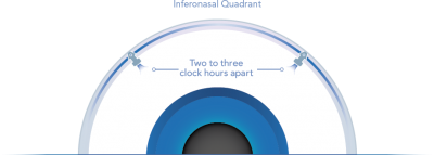 iStent Inject Advantage - Costello Eye Physicians & Surgeons